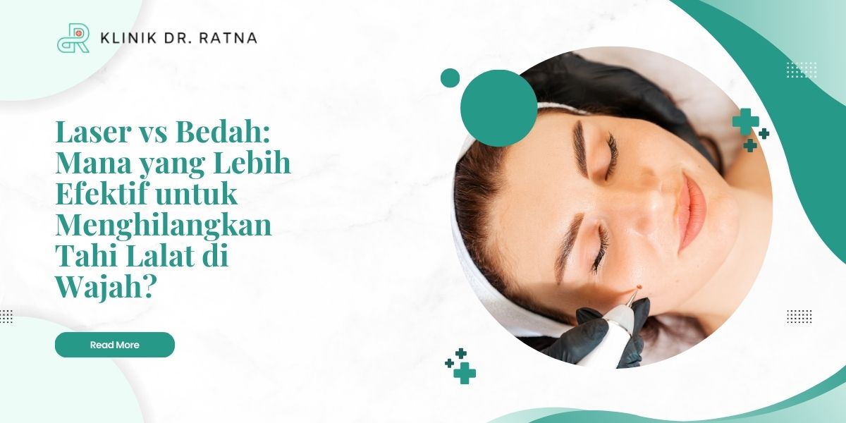 Laser Vs Bedah: Mana Yang Lebih Efektif Untuk Menghilangkan Tahi Lalat ...